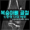 복숭아뼈 골절 발목 골절 개방적 정복술 및 금속판 고정하는 방법 제이본정형외과 권제호 네이버 블로그